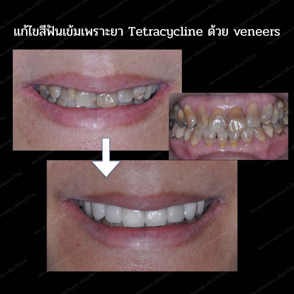 วีเนียร์ – Smile Operations